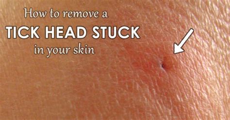 How To Remove A Tick Head Stuck In Your Skin