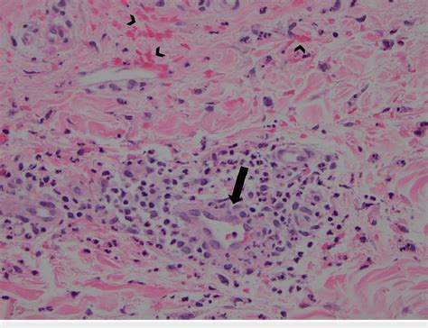 Skin Biopsy Specimen With Hematoxylin And Eosin Staining Showing