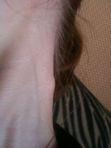 Появился шарик на шее Что это может быть User 42182005 Ответы Mail