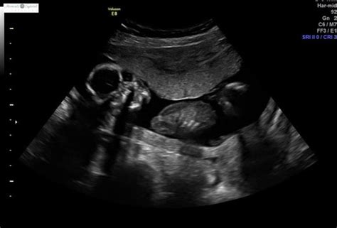 The Placenta And Umbilical Cord Flashcards Quizlet