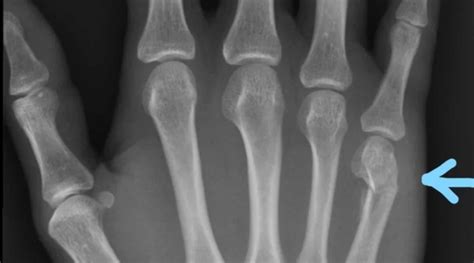Metacarpal Base Fracture Treatment Archives Samarpan Physiotherapy