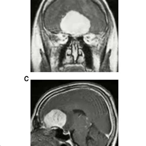 A Case Of Clinoidal Meningioma Successfully Operated On Through