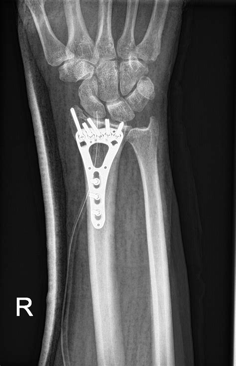 Die Punch Fracture Classification At Sabrina Swensen Blog