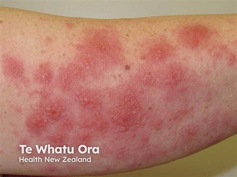 Acute Febrile Neutrophilic Dermatosis Images