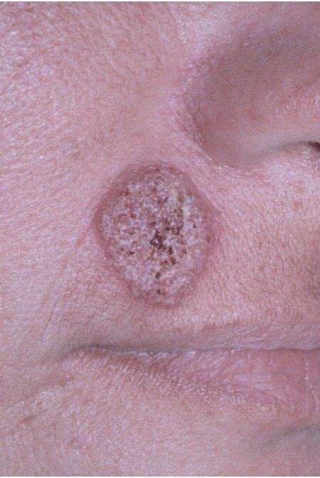 Blastomycosis Medizzy