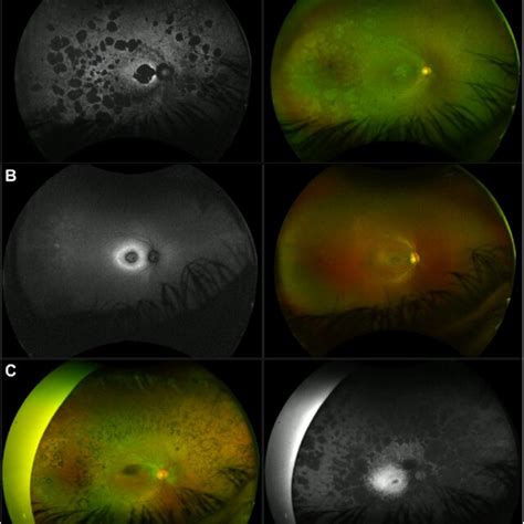 Visual Acuity In Cerkl Associated Retinal Dystrophy A Mean Visual