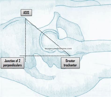 Bryant S Triangle Examination Of Hip Epomedicine