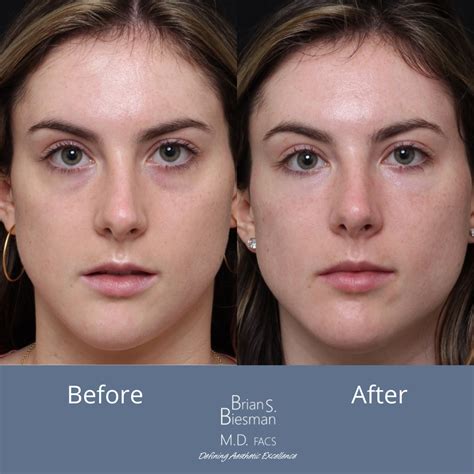Tear Trough Under Eye Hollows Correction Nasvhille Tn Tear Trough Face Fillers Undereye