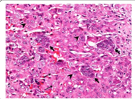 Hande Staining At × 400 Magnification Shows Proliferation Of Stromal