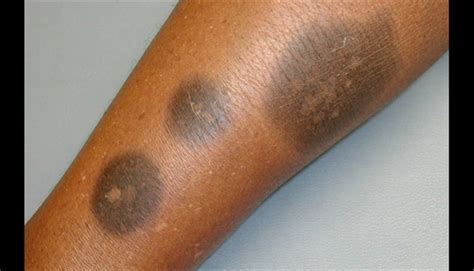 Hyperpigmented Annular Patches Clinical Advisor