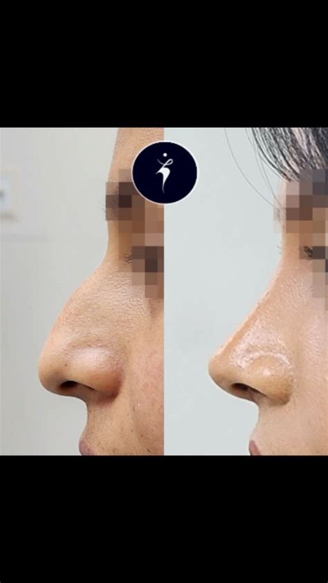 Rinoplastiadrrospigliosi 👉rinoplastia Dr Rospigliosi Les