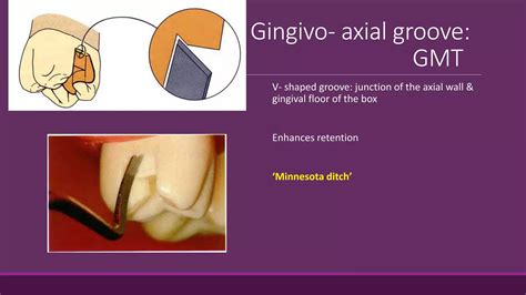 Class Ii Inlay Ppt