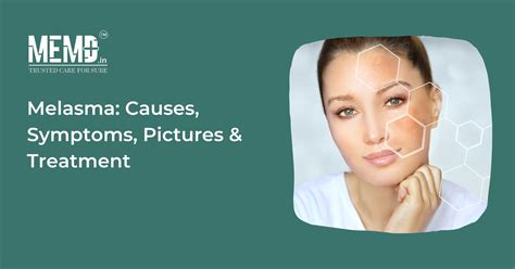 Melasma Causes Symptoms Pictures And Treatment Memd Healthtech