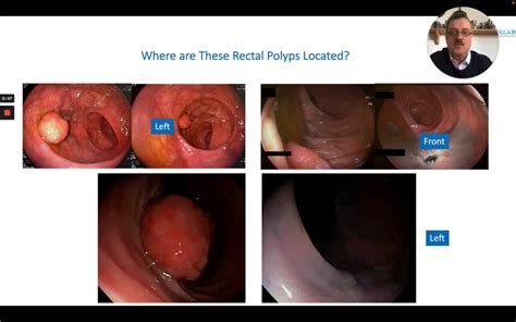 Endocollab™ Gastroenterology And Endoscopy Education On Linkedin Spatial Orientation During