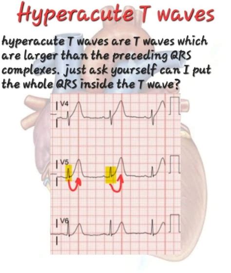 Hyperacute T Wave Medizzy
