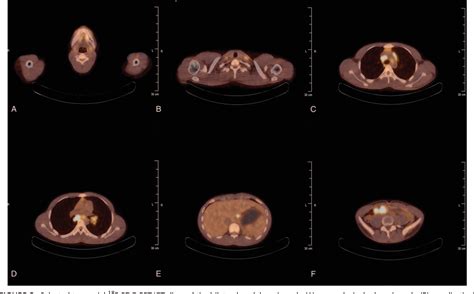 Figure 1 From A Case Report Systemic Lymph Node Tuberculosis Mimicking