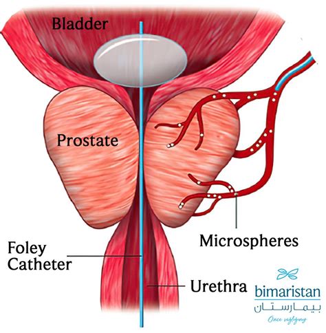 Prostatic Artery Embolization In Turkey بيمارستان