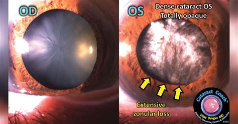 Consider Manual Shelved Incision Cataract Surgery For Dense Brunescent