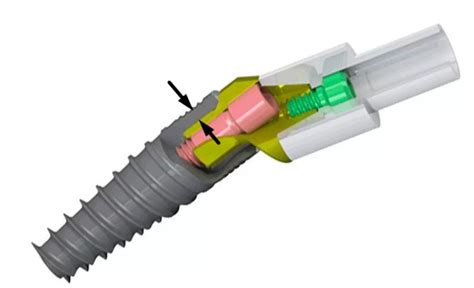 Angled Multi Unit Abutments Uniqa Dental