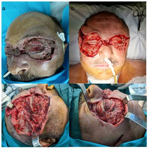 Multidisciplinary Approach In Rare Fulminant Progressing And Life