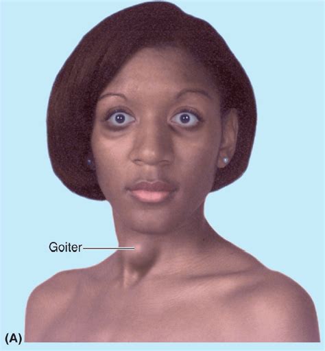 Thyroid Swelling Goiter Head And Neck Clinical Cases Saturn Medic