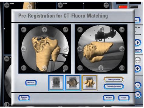 3 Shows The Navigation Display Vectorvison Spine Brainlab After 2d Download Scientific