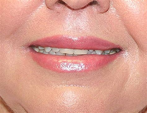 Phenol Peel Before And After Photos The Clinic For Plastic Surgery