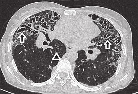 Hypersensitivity Pneumonitis Axial High Resolution Computed