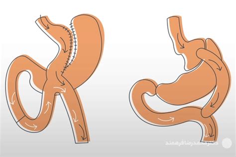 عمل مینی بای پس تفاوت بای پس و مینی بای پس دکتر محمدرضا فرهمند