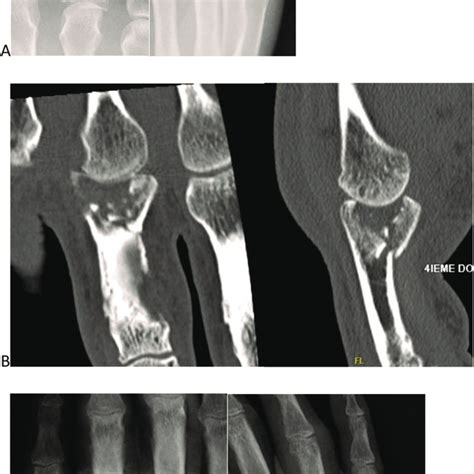 Preoperative And Postoperative Imaging For Patient 1 Preoperative