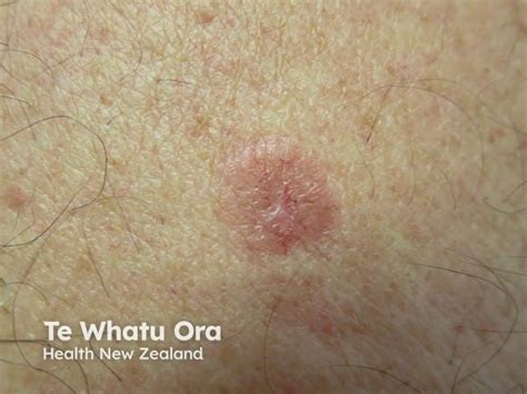 Nodular Basal Cell Carcinoma Images
