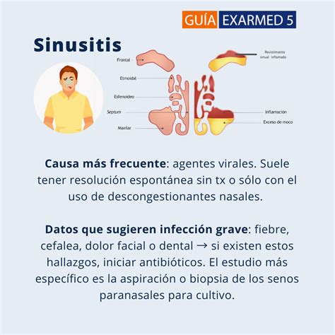 Guia Exarmed Enarm Sinusitis Aguda Es La Inflamación De