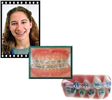 Morgan Brace Guard For Braces