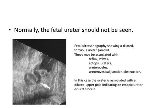 Antenatal Hydronephrosis