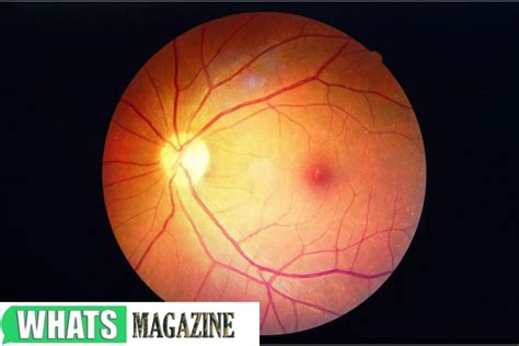 Healthy Retina Vs An Unhealthy Retina Signs You Might Have A Retinal