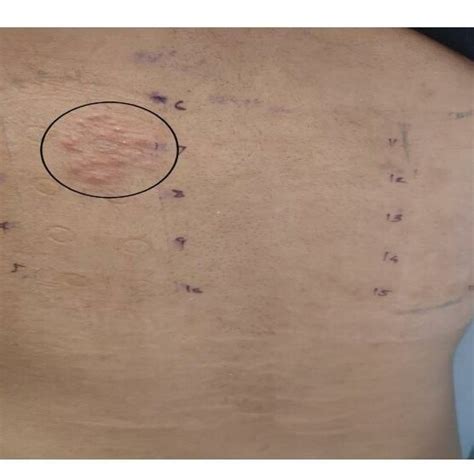 Patch Test Units Applied Over Back Download Scientific Diagram