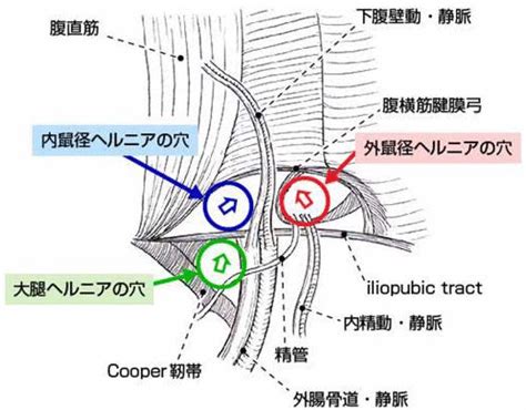 当院における鼠径部ヘルニア手術の取り組み ｜ 国立長寿医療研究センター