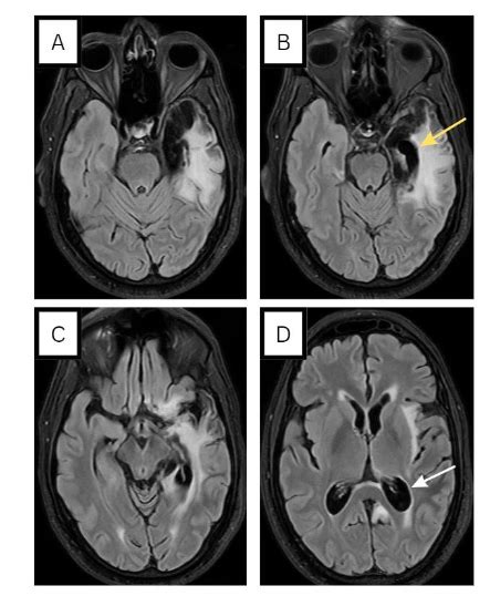 Non Convulsive Status Epilepticus Post Hsv Encephalitis European