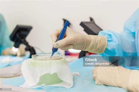 현미경의 밑에 닥터는 머리 여포를 다시 계산합니다 대머리 치료 모발 이식 머리의 부분에서 모낭을 이동하는 외과 기술 건강관리와 의술에 대한 스톡 사진 및 기타 이미지