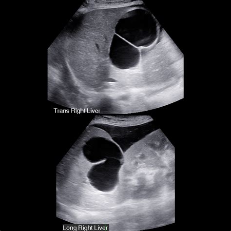 Pediatric Gallbladder Hydrops Pediatric Radiology Reference Article