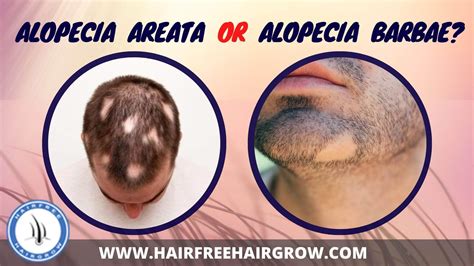 Alopecia Areata Treatment For Men