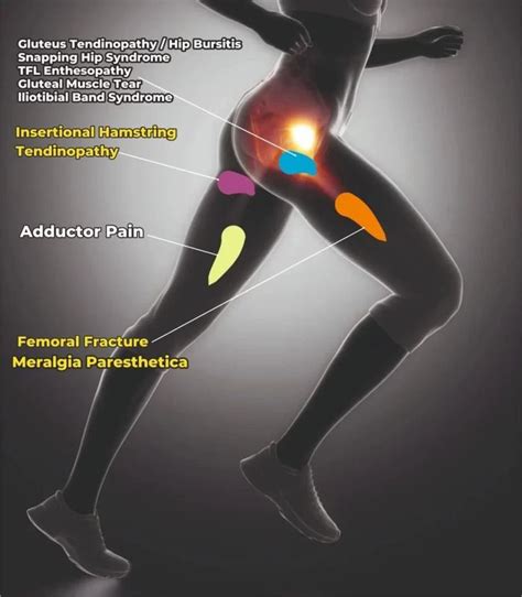 Hip Pain Location Diagram Hip Pain Musculoskeletal Pain Hip Flexor Pain