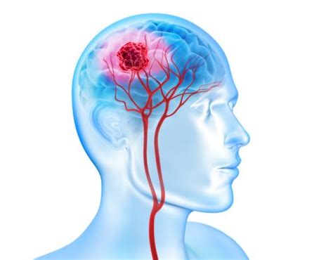 Brain Arteriovenous Malformation Supreme Vascular And Interventional Clinic