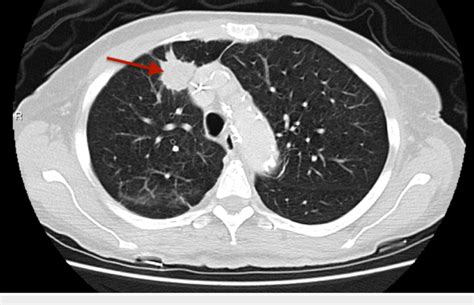 Axial Cect Contrast Enhanced Computed Tomography Scan Of The Chest
