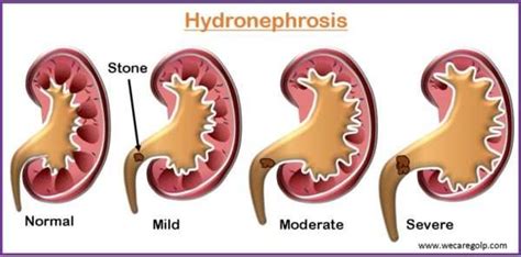 Hydronephrosis Urinary Tract Dilatation We Care