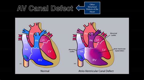 Fetal Echocardiography Av Canal Defect Youtube