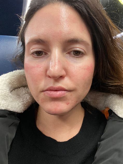 Review Of Morpheus8 Cascades Med Spa