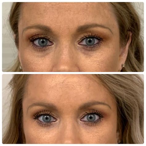 What Wrinkle Before And After Of Botox In The Glabella