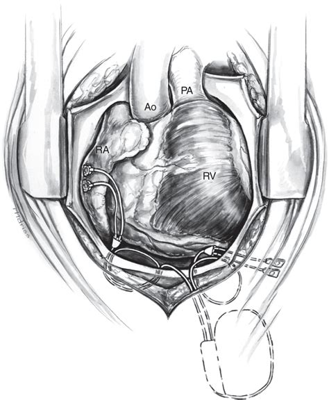 Surgical And Transcatheter Management Of Arrhythmias Thoracic Key