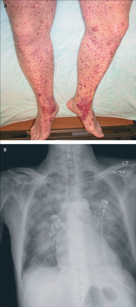 Subacute And Acute Infective Endocarditis The Lancet